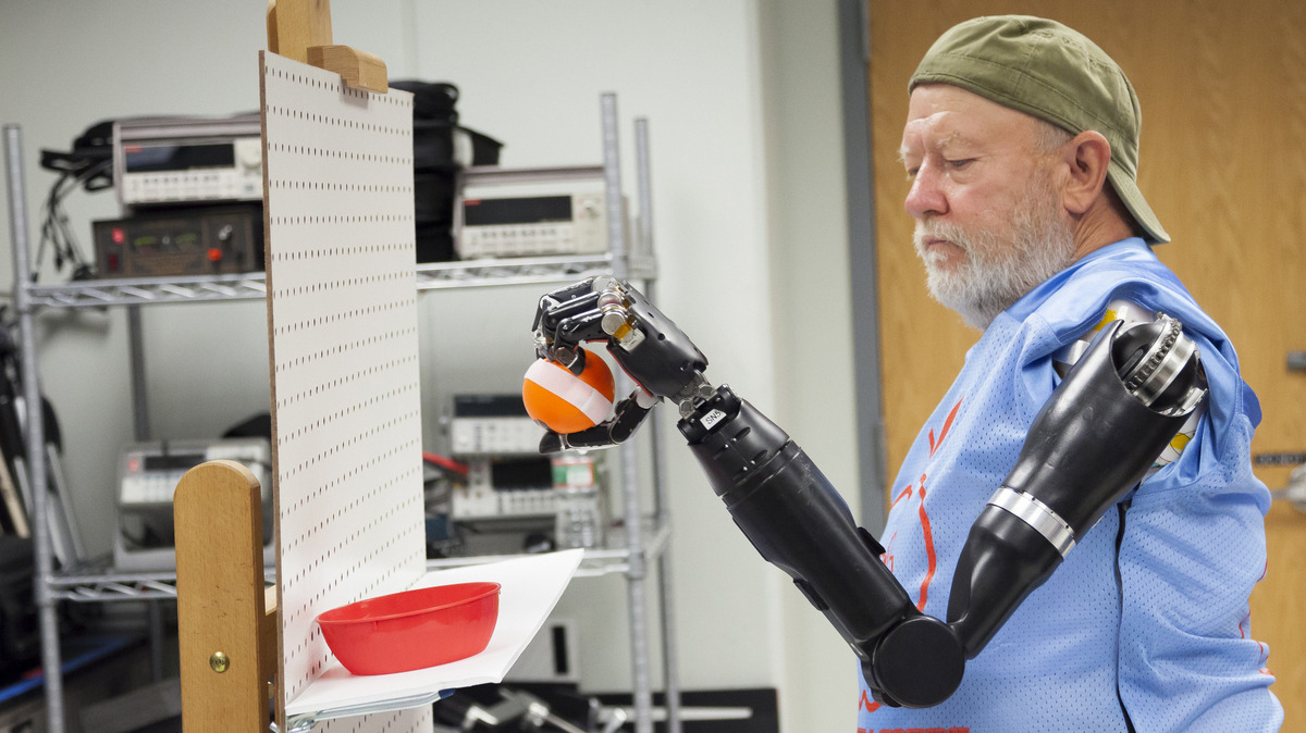 Man Uses Bionic Arms After 40 Years And Is The First One Using Them ...