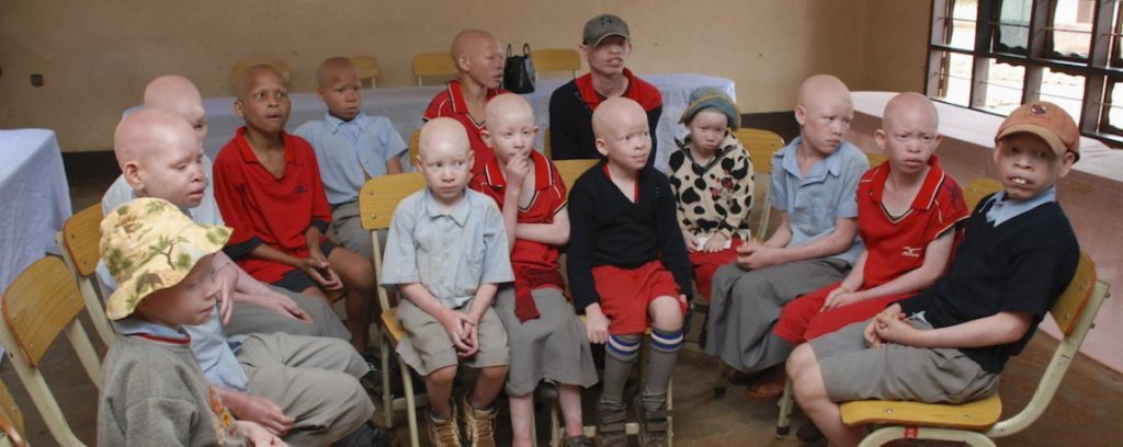 Albino Killings: Ritual Killers Hunt Albinos like Animals in Africa